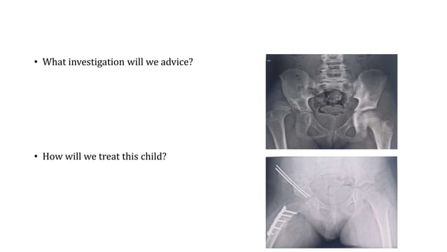 DDH (Developmental Dysplasia of Hip).pptx