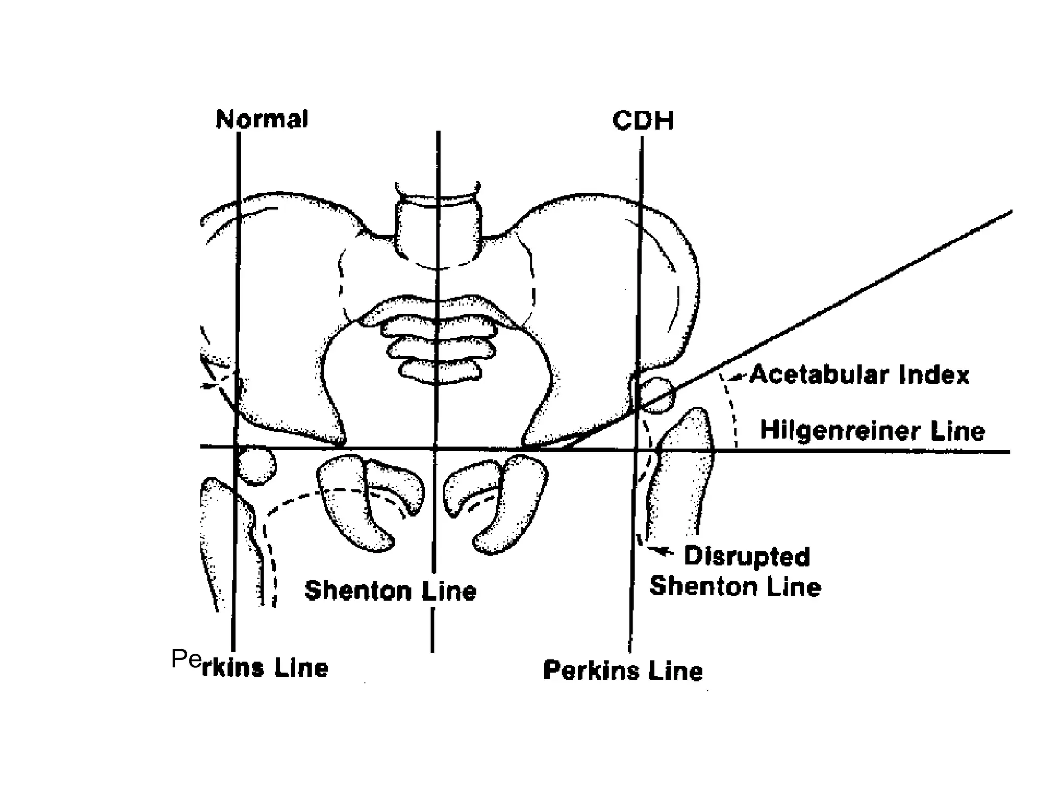 Developmental dysplasia of the hip overview | PPT