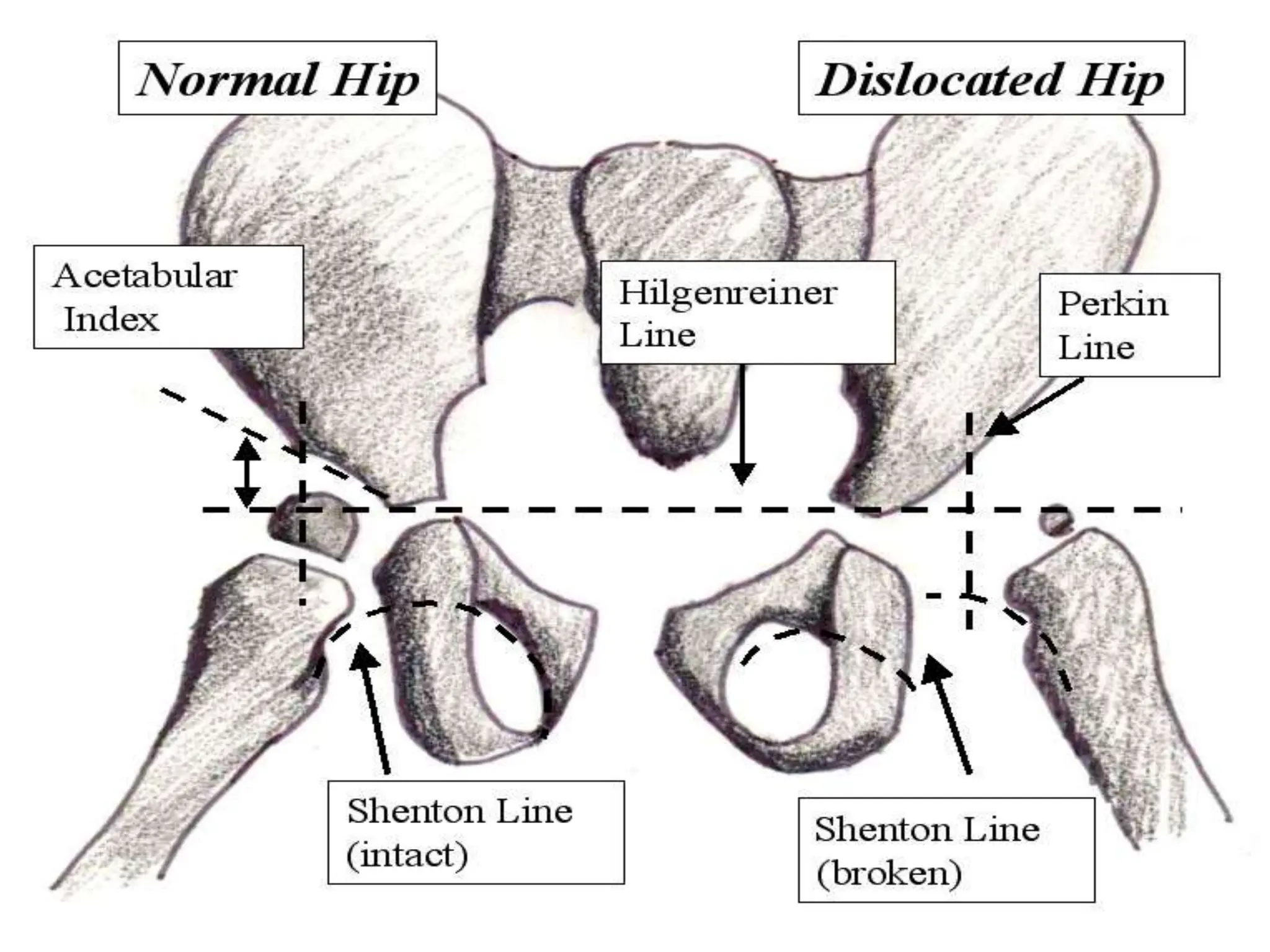 Developmental dysplasia of the hip overview | PPT