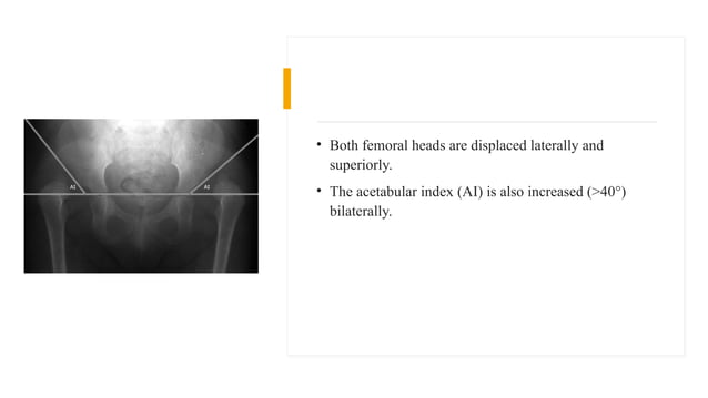 DDH assesment in newborns screening.pptx