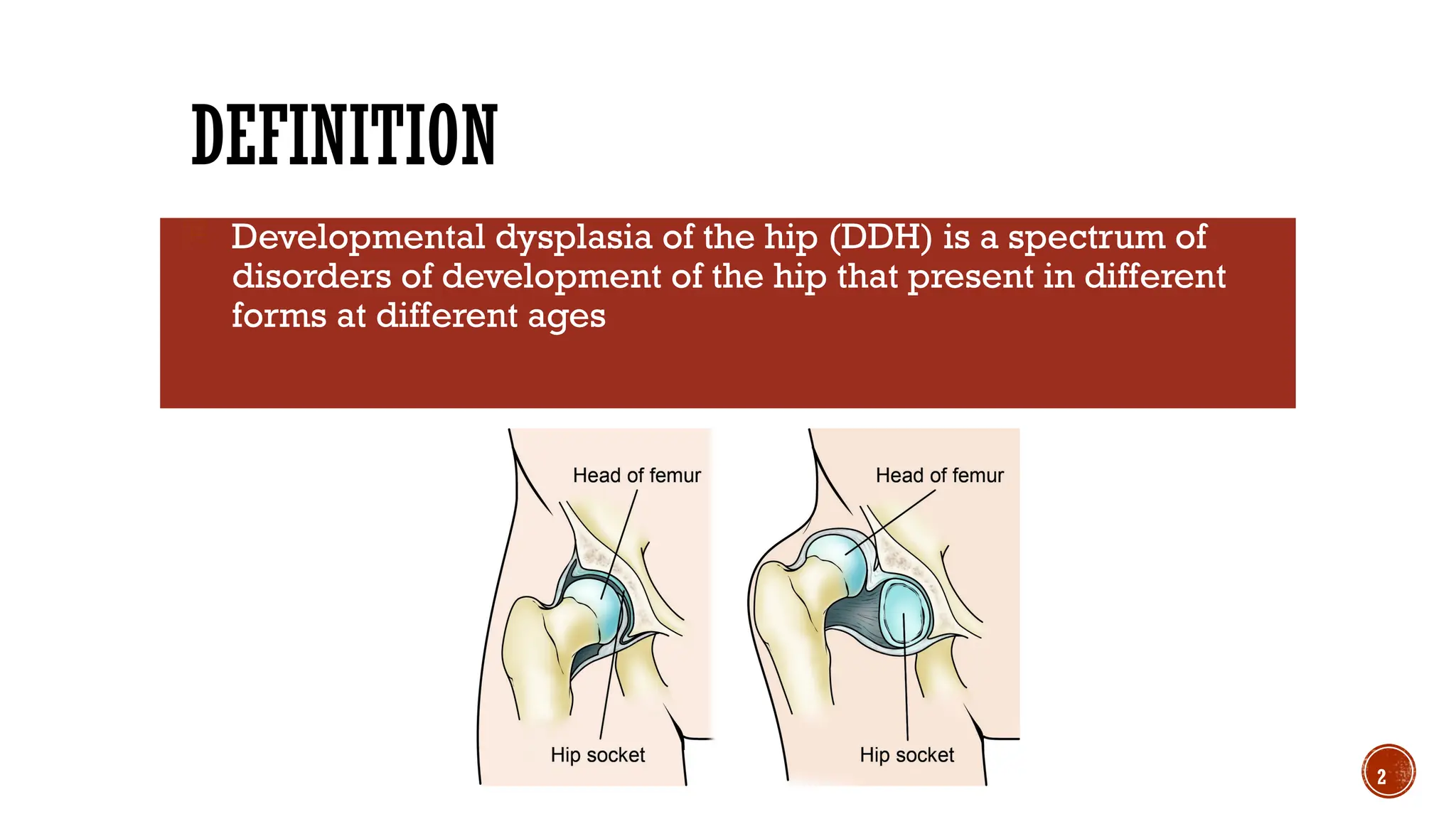Developmental dysplasia of the hip literature | PPTX