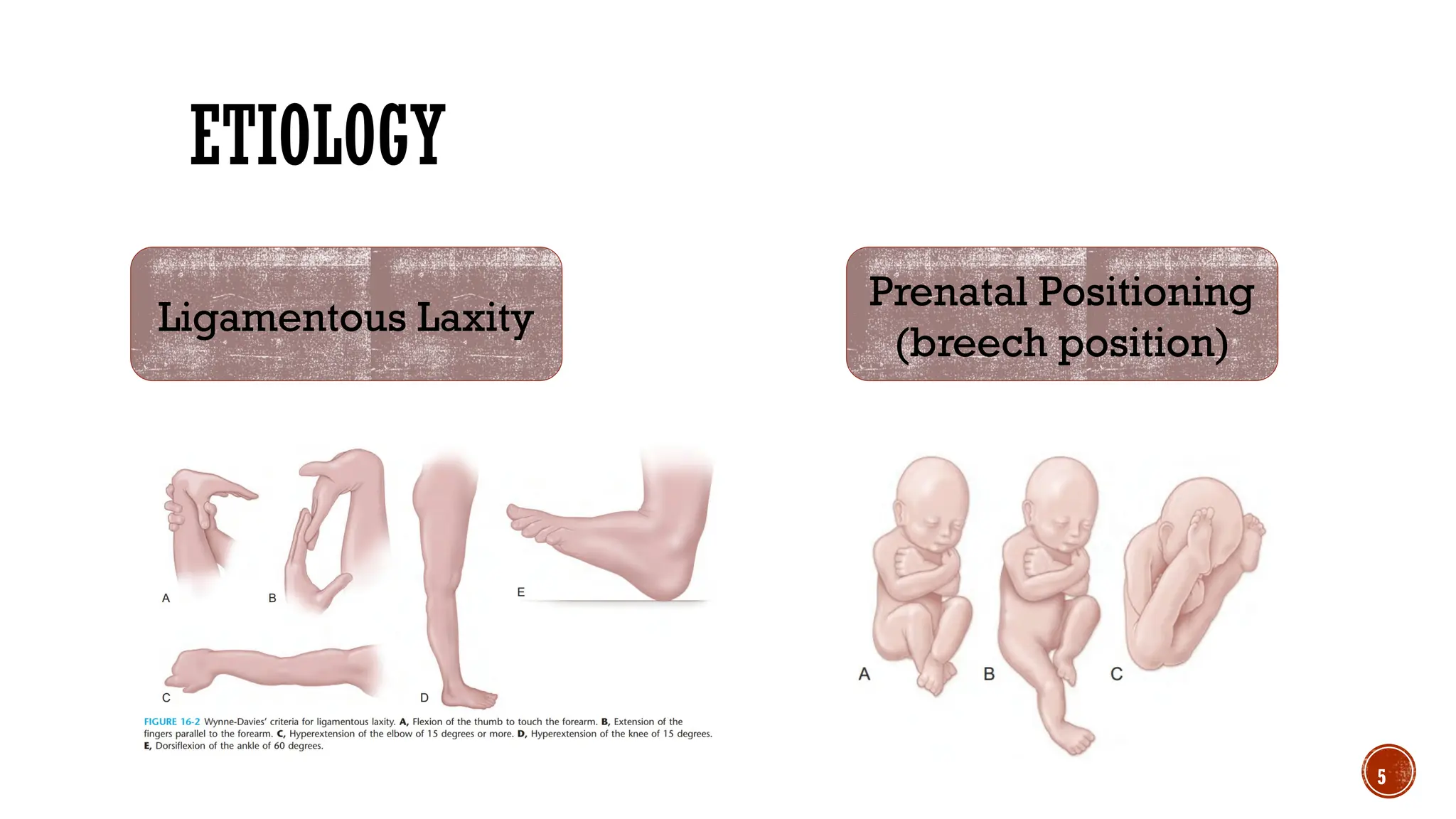 Developmental dysplasia of the hip literature | PPTX