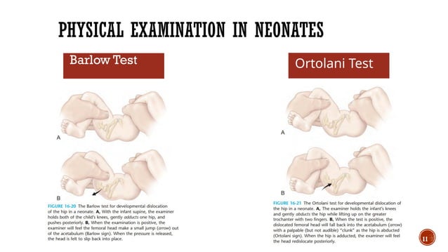 Developmental dysplasia of the hip literature | PPT