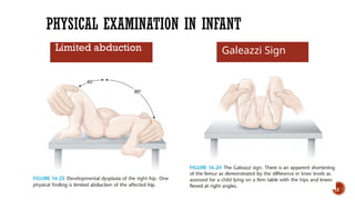 Developmental dysplasia of the hip literature | PPTX