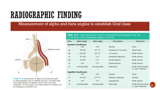 Developmental dysplasia of the hip literature | PPTX