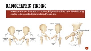 Developmental dysplasia of the hip literature | PPTX