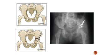 Developmental dysplasia of the hip literature | PPTX