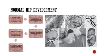 Developmental dysplasia of the hip literature | PPTX