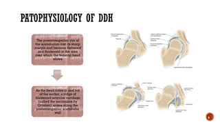 Developmental dysplasia of the hip literature | PPTX