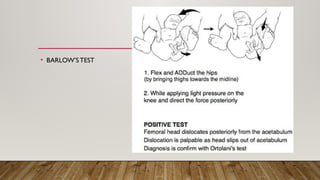 Clinical accessment of developmental dysplasia of hip | PPTX
