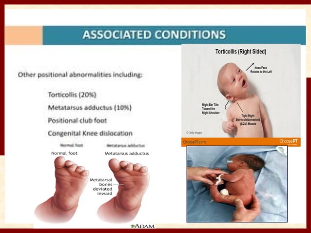 DDH.pptx Developmental dysplasia of hips | PPTX