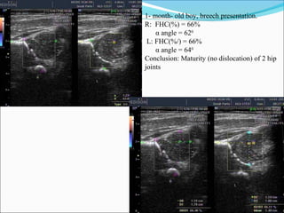 DEVELOPMENTAL DYSPLASIA of THE NEONATAL HIP JOINT, Dr TRẦN NGÂN CHÂU | PPT