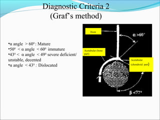 DEVELOPMENTAL DYSPLASIA of THE NEONATAL HIP JOINT, Dr TRẦN NGÂN CHÂU | PPT