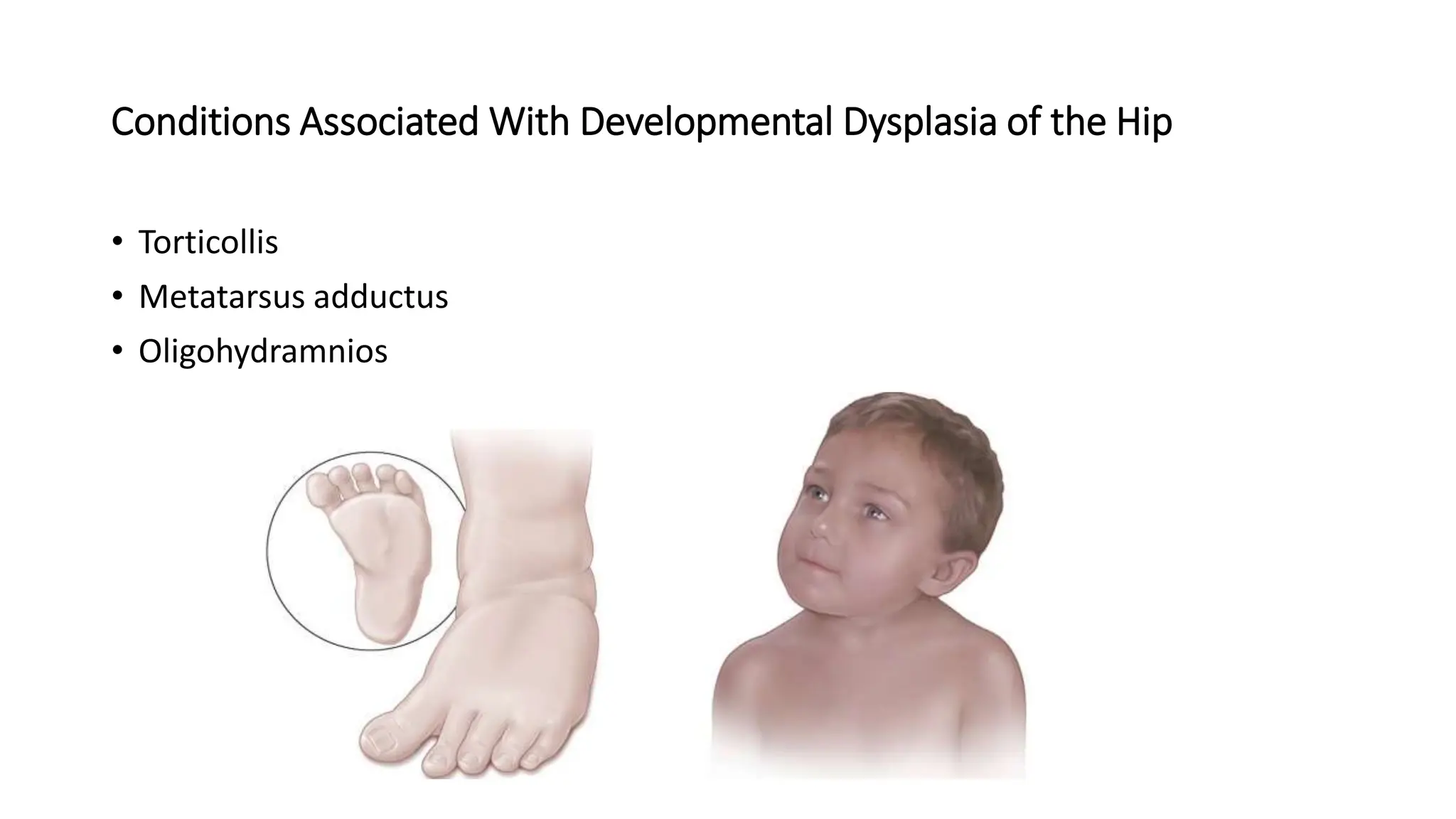 ddh-PRESENTATION in orthopaedics and anatomy.pptx