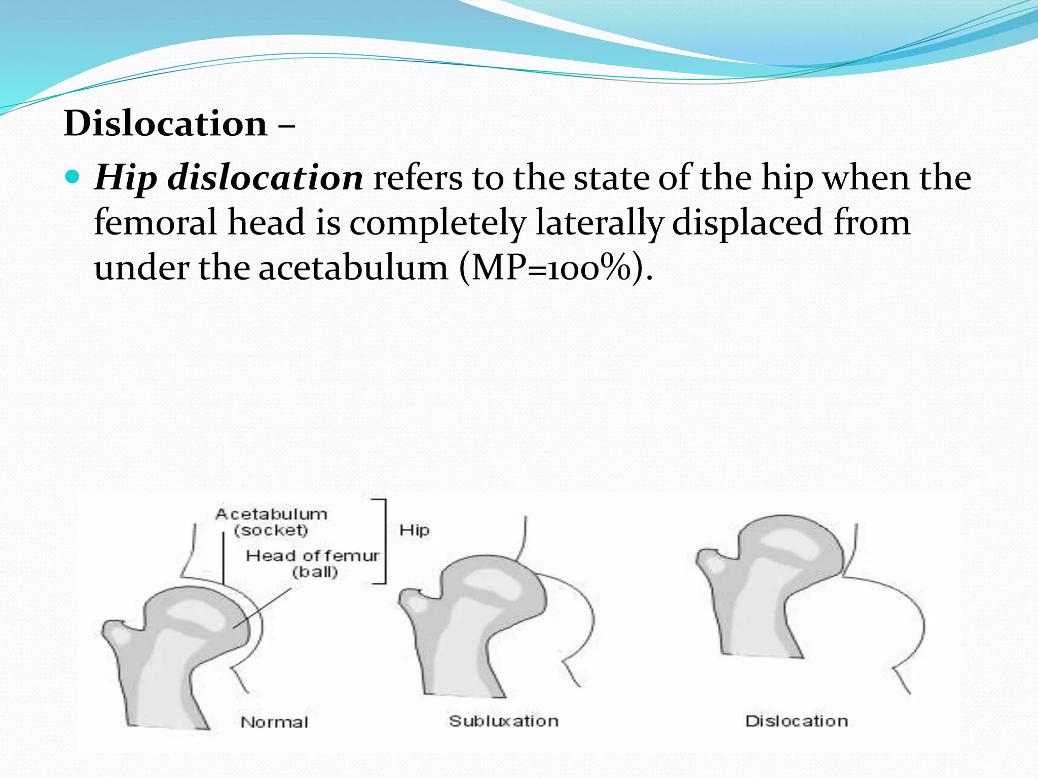 Hip dislocation | PPSX