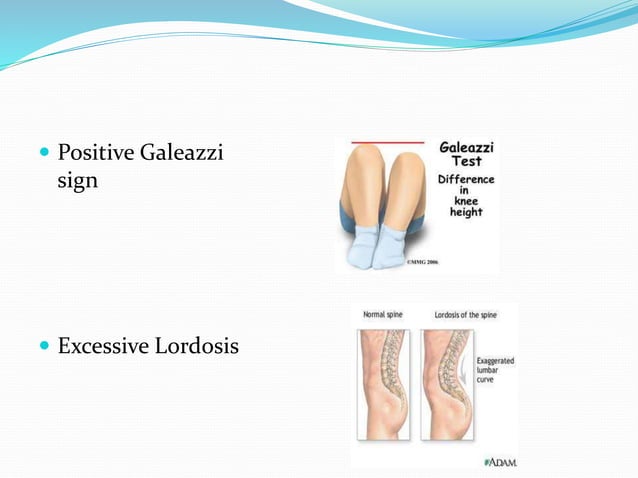 Hip Dislocation Ppt 4104
