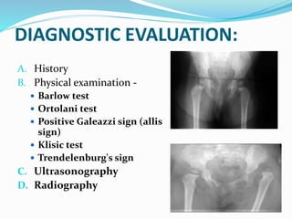 Hip dislocation | PPSX