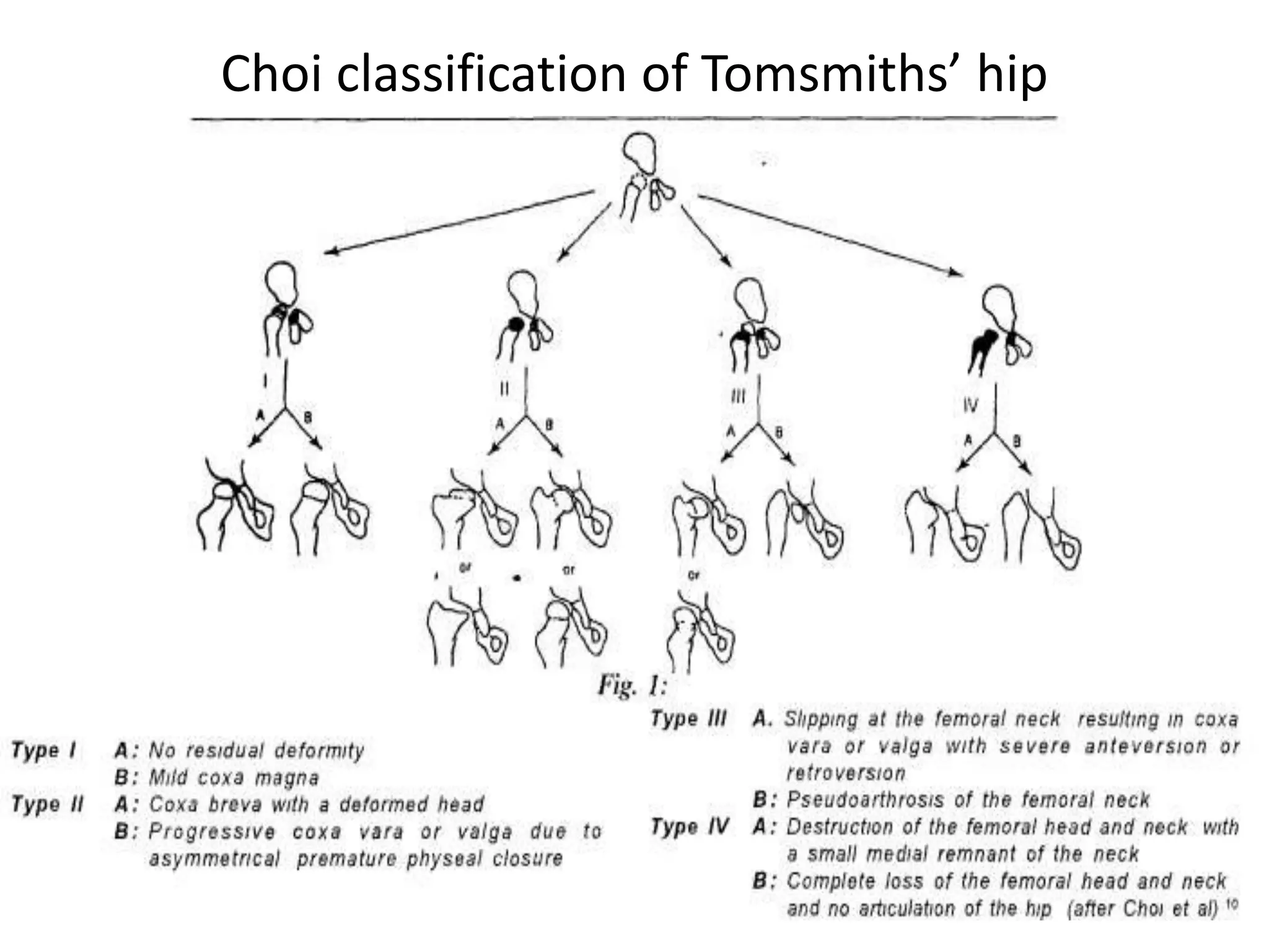 Developmental dysplasia of hip | PPT