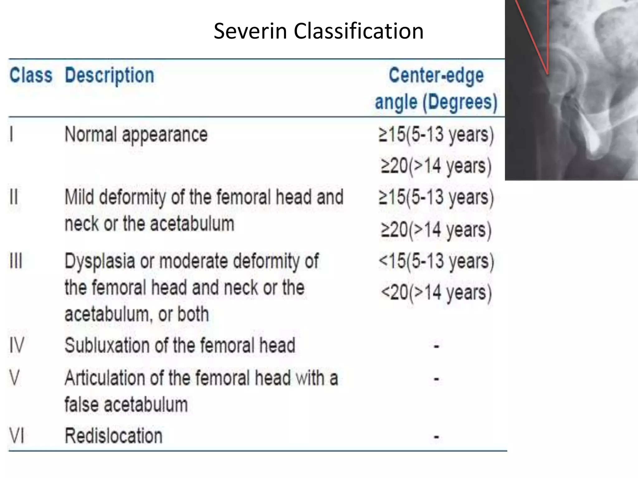 Developmental dysplasia of hip | PPT