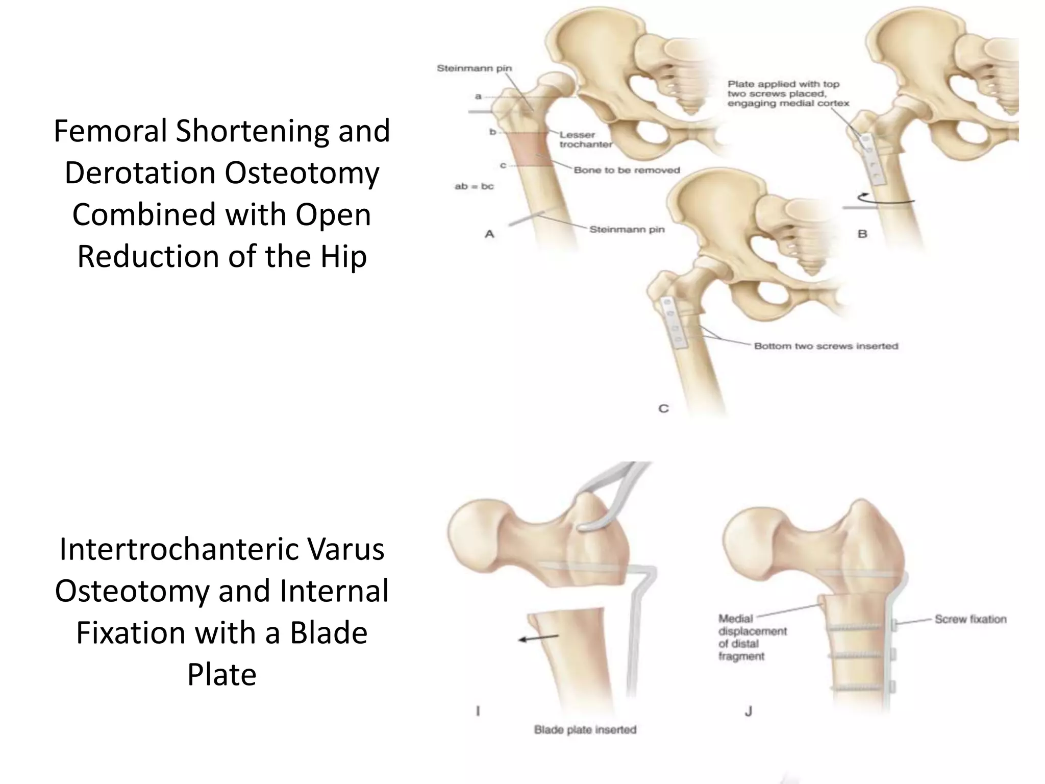 Developmental dysplasia of hip | PPT