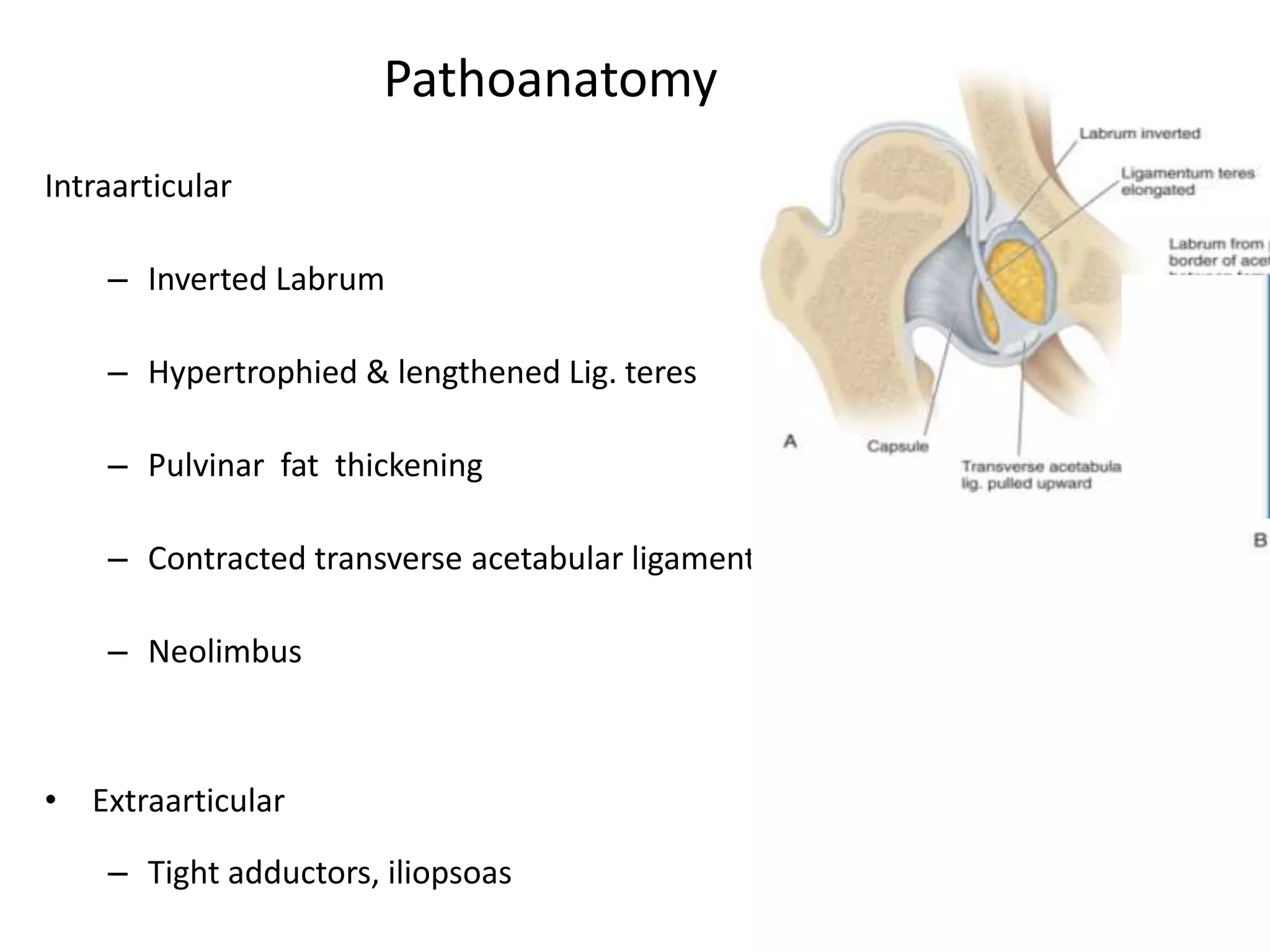 Developmental dysplasia of hip | PPT