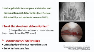 DDH in ADOLESCENTS overview of diagnosis and treatment.pptx