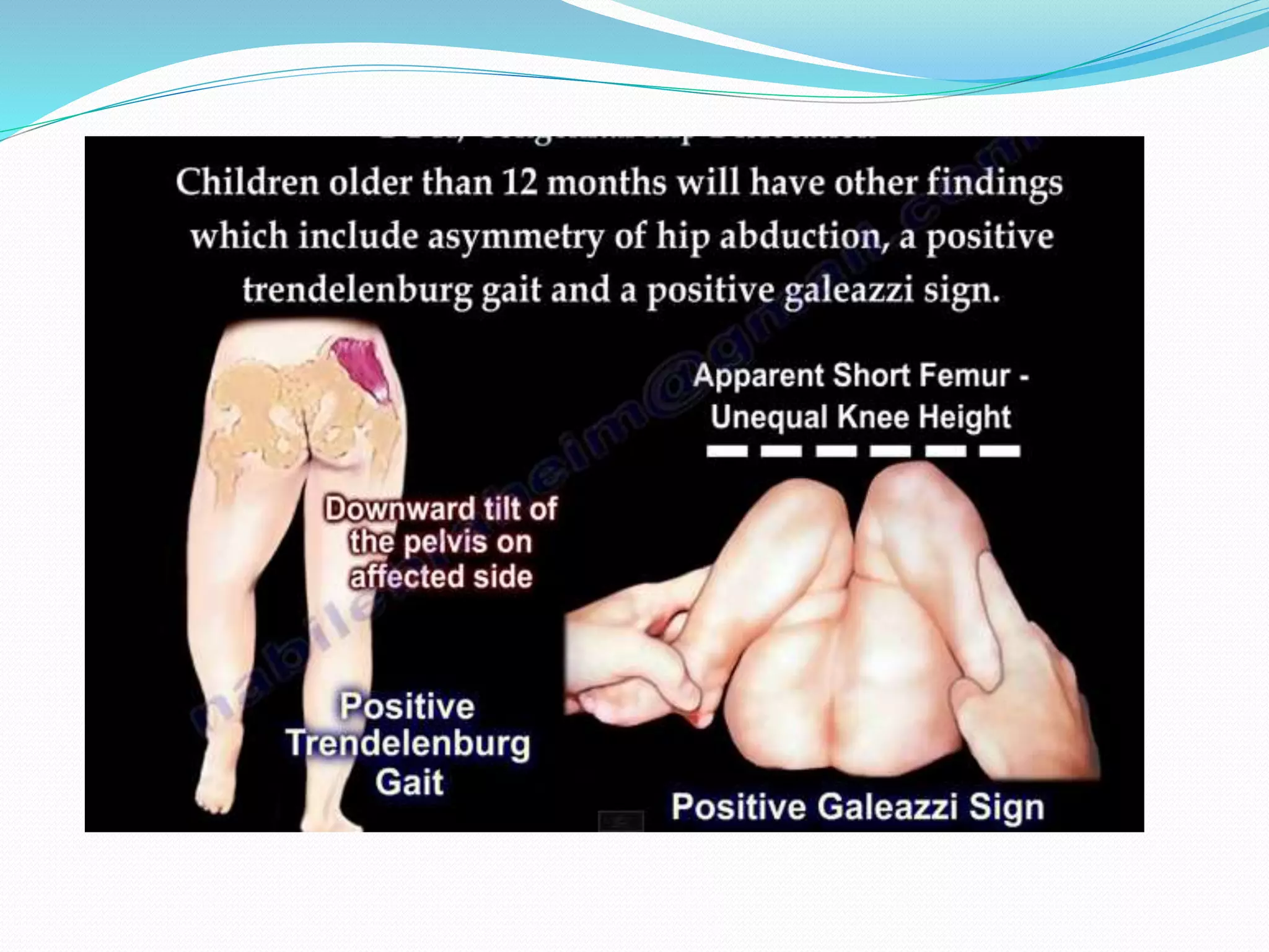 Developmental Dysplasia of Hip | PPTX