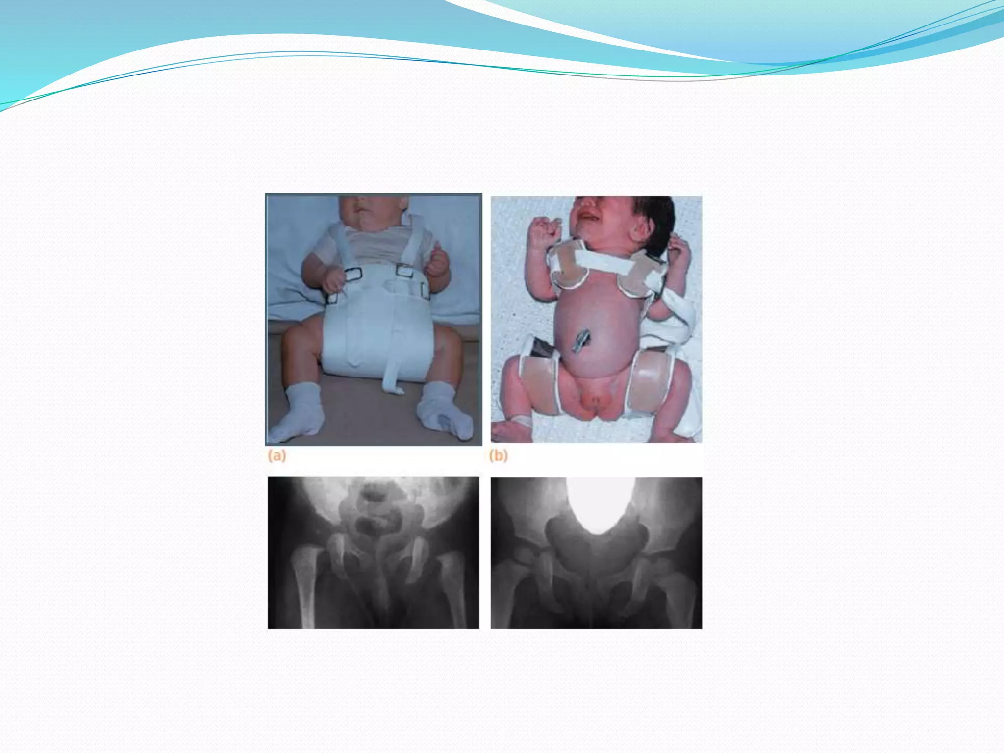 Developmental Dysplasia of Hip | PPTX