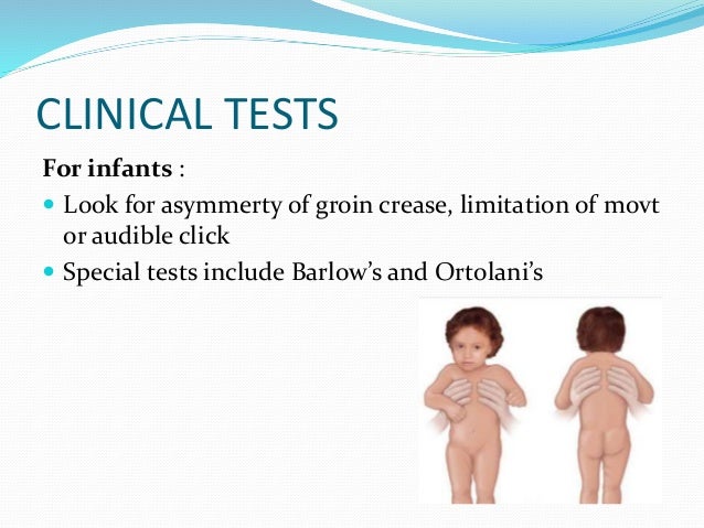 Developmental Dysplasia of Hip