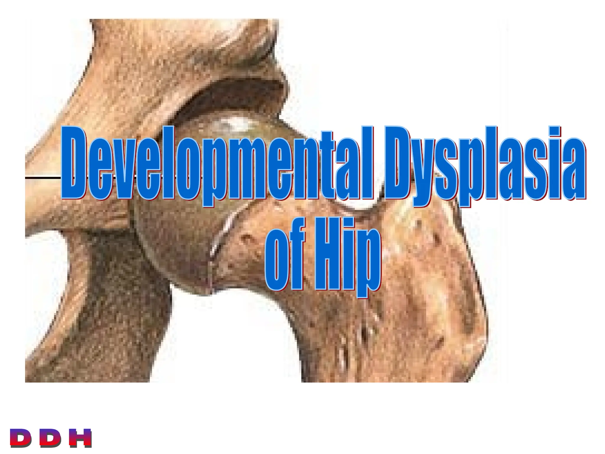 DDH Developmental Dysplasia of the Hip.ppt