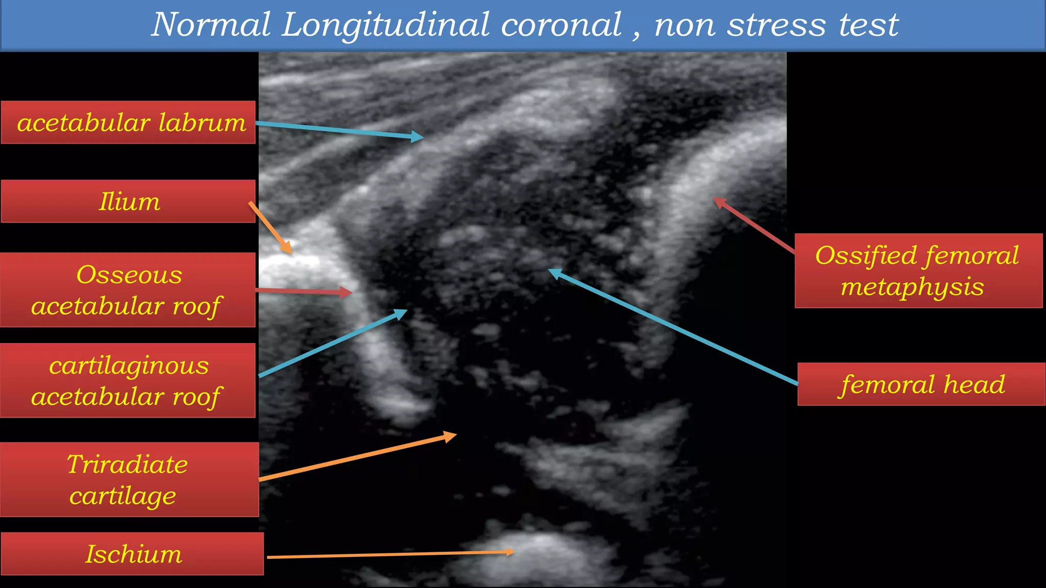 Ultrasound of Developmental dysplasia of hip Joint ..Dr.Mohamed Soliman ...