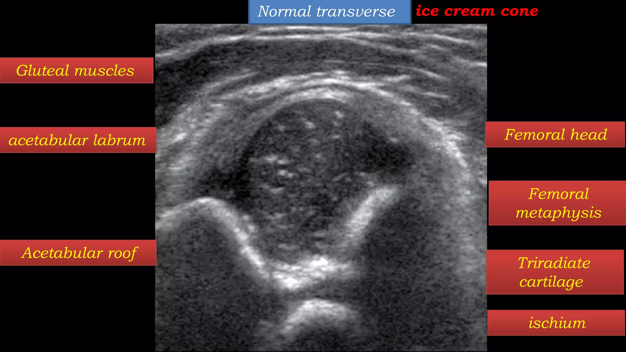 Ultrasound of Developmental dysplasia of hip Joint ..Dr.Mohamed Soliman ...