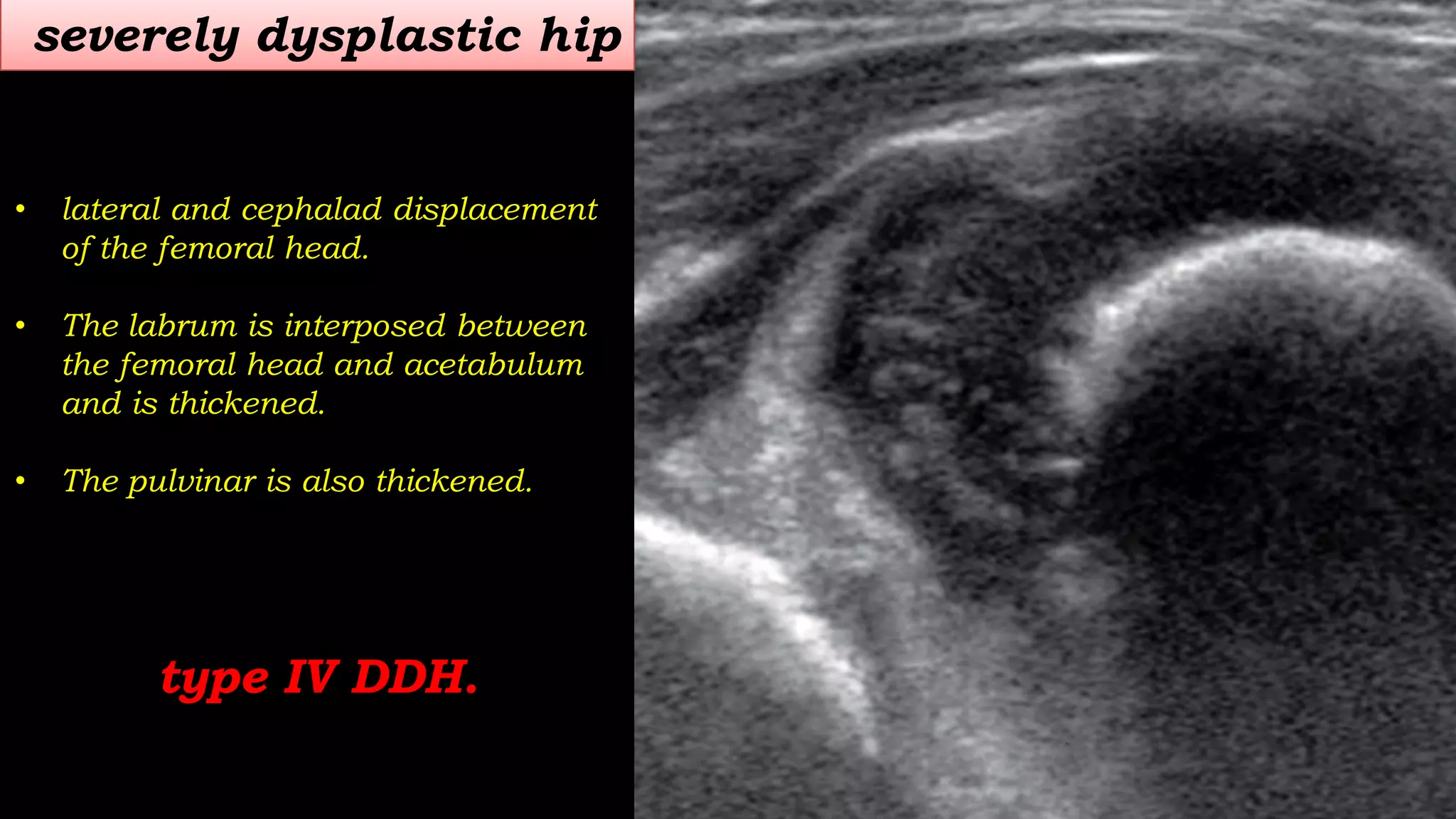 Ultrasound of Developmental dysplasia of hip Joint ..Dr.Mohamed Soliman ...