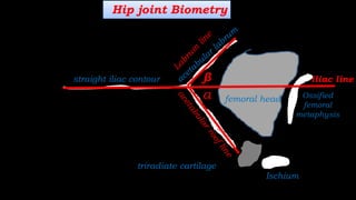 Ultrasound of Developmental dysplasia of hip Joint ..Dr.Mohamed Soliman ...