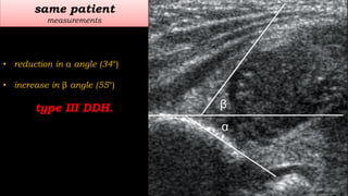 Ultrasound of Developmental dysplasia of hip Joint ..Dr.Mohamed Soliman ...