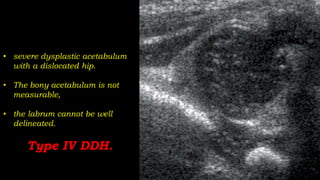 Ultrasound of Developmental dysplasia of hip Joint ..Dr.Mohamed Soliman ...