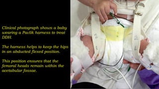 Ultrasound of Developmental dysplasia of hip Joint ..Dr.Mohamed Soliman ...