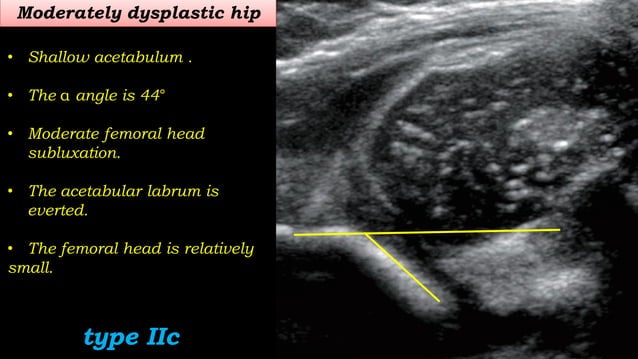 Ultrasound of Developmental dysplasia of hip Joint ..Dr.Mohamed Soliman