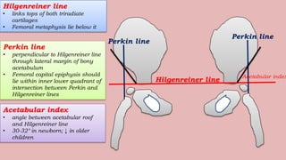 Ultrasound of Developmental dysplasia of hip Joint ..Dr.Mohamed Soliman ...