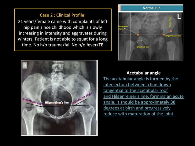 Ddh final dt2 | PPTX | Bone and Joint Conditions | Diseases and Conditions