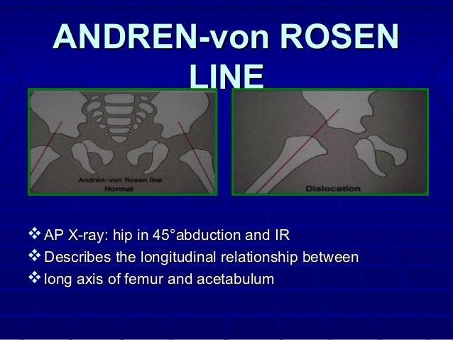developemental dysplasia of hip
