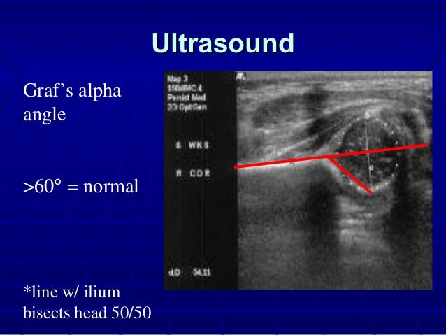 developemental dysplasia of hip