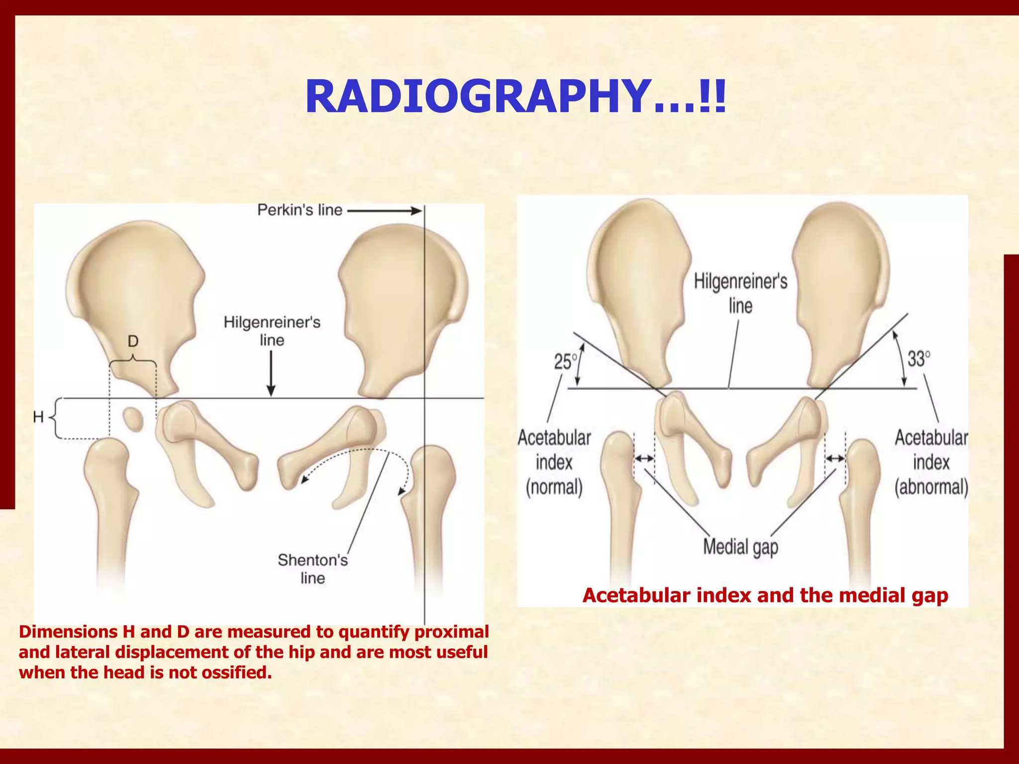 Devlopmental dysplasia of hip(DDH) by DR.NAVEEN RATHOR | PPTX