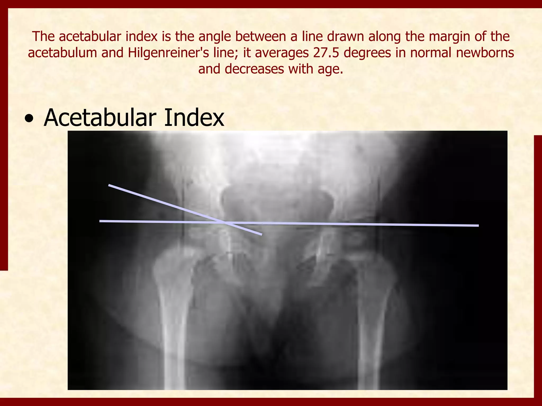 Devlopmental dysplasia of hip(DDH) by DR.NAVEEN RATHOR | PPTX