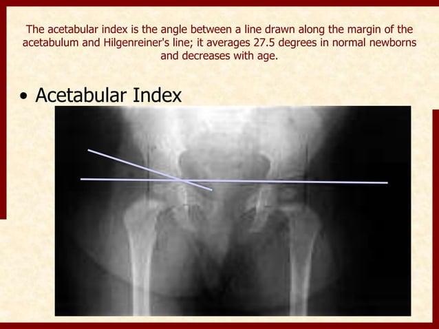 Devlopmental dysplasia of hip(DDH) by DR.NAVEEN RATHOR | PPTX ...