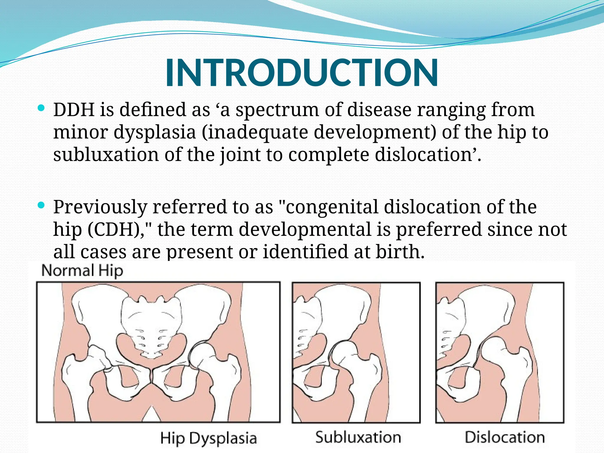 Developmental Dysplasia of Hip (DDH) or Congenital Dislocation of Hip (CDH) | PPTX