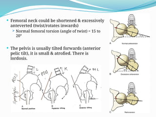Developmental Dysplasia of Hip (DDH) or Congenital Dislocation of Hip ...