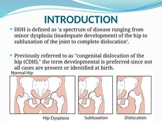 Developmental Dysplasia of Hip (DDH) or Congenital Dislocation of Hip (CDH) | PPTX | Pregnancy ...