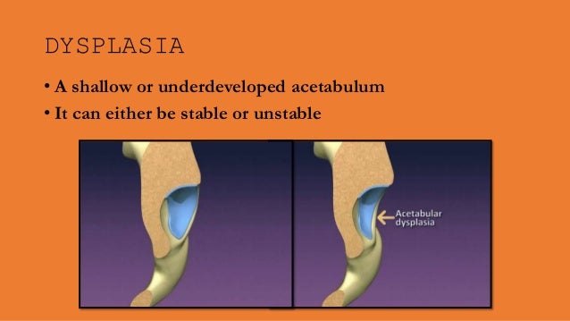 Developmental Dysplasia of hip