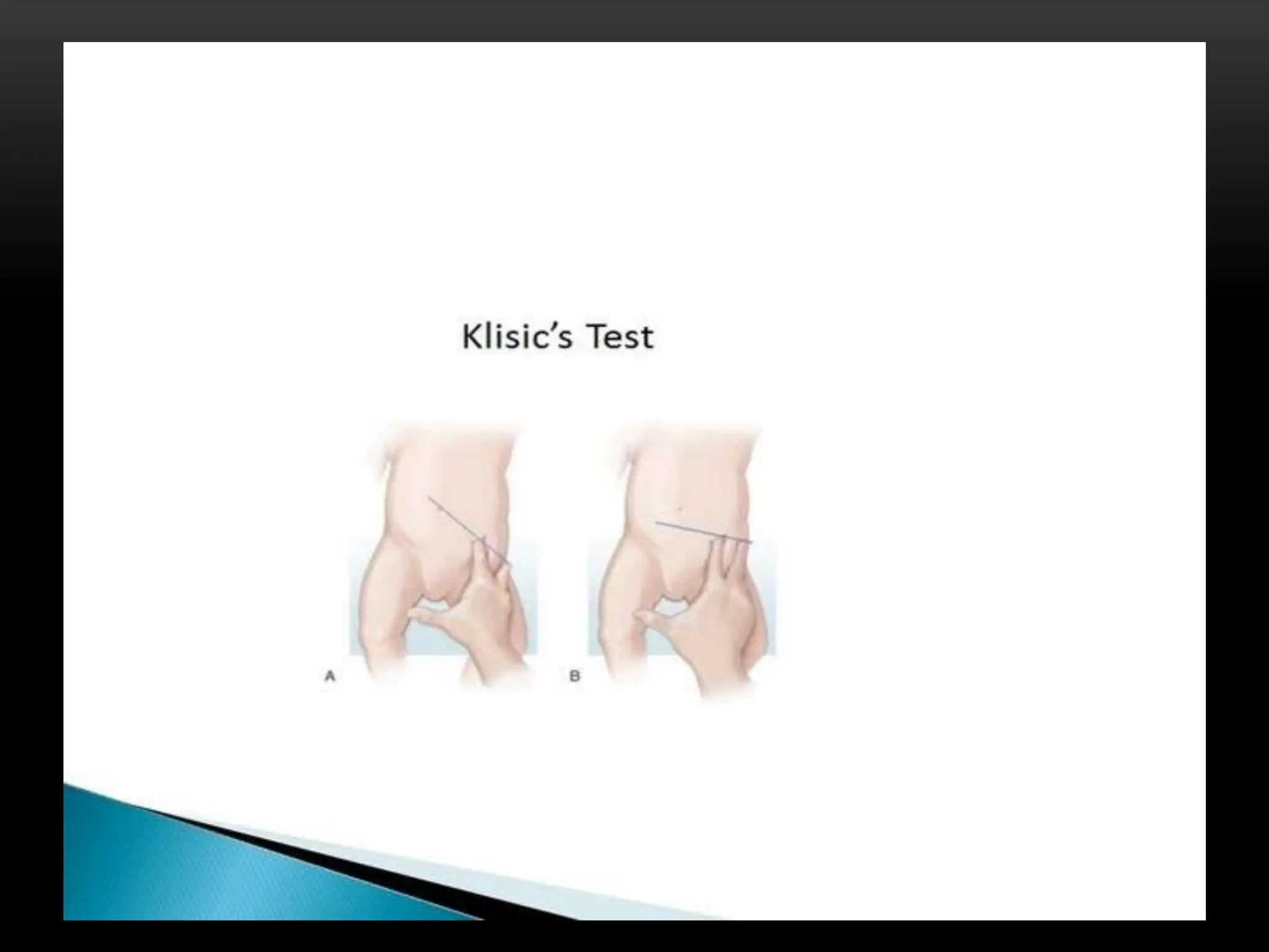 Developmental dysplasia of hip joint (DDH) | PPTX